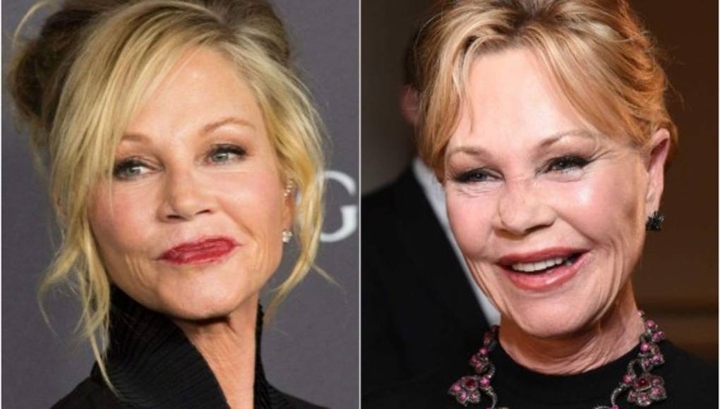 Melanie Griffith luce irreconocible tras operación por cáncer de piel ...