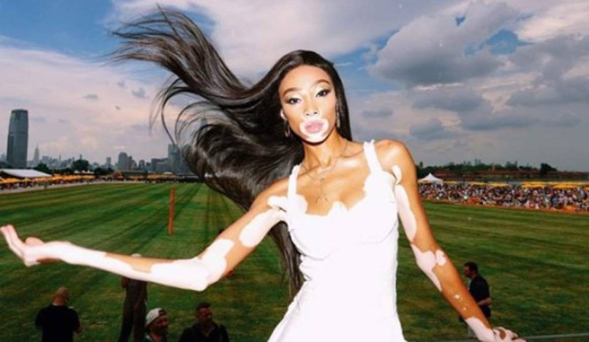 Winnie Harlow, la modelo con vitiligo que derrotó la perfección de ...