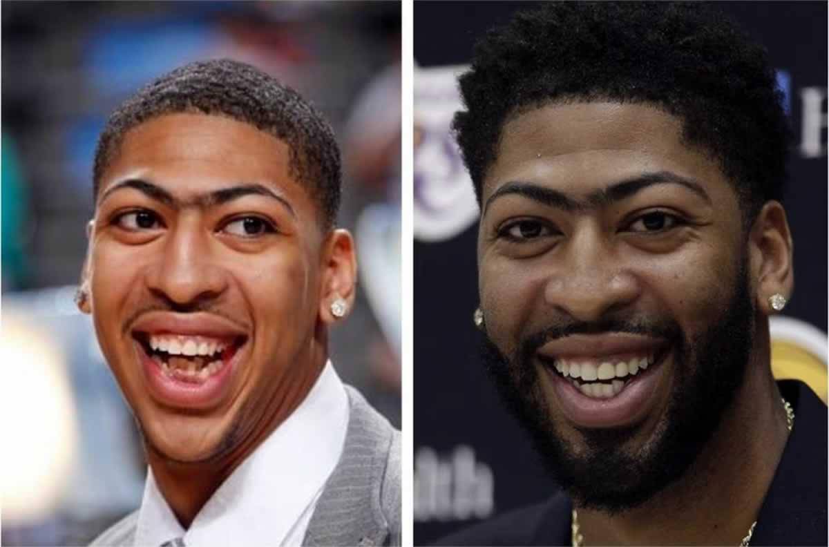 Anthony Davis 2023 Dientes