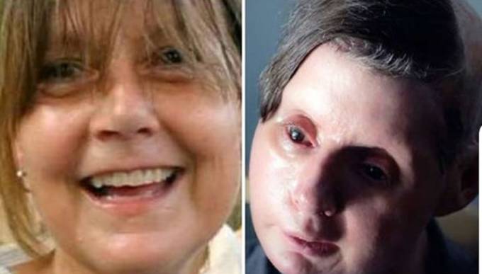 Vídeo: La mujer a la que un chimpancé le arrancó la cara y las manos - Diario La Prensa